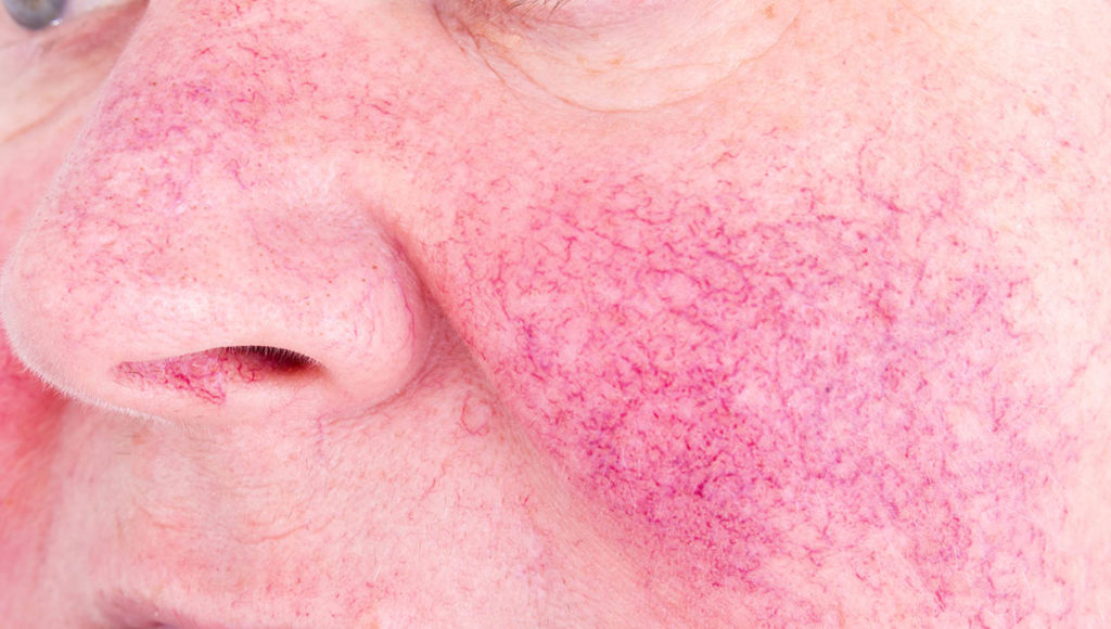 Rougeurs et Vaisseaux - Centre Laser Dermatologique du Limousin