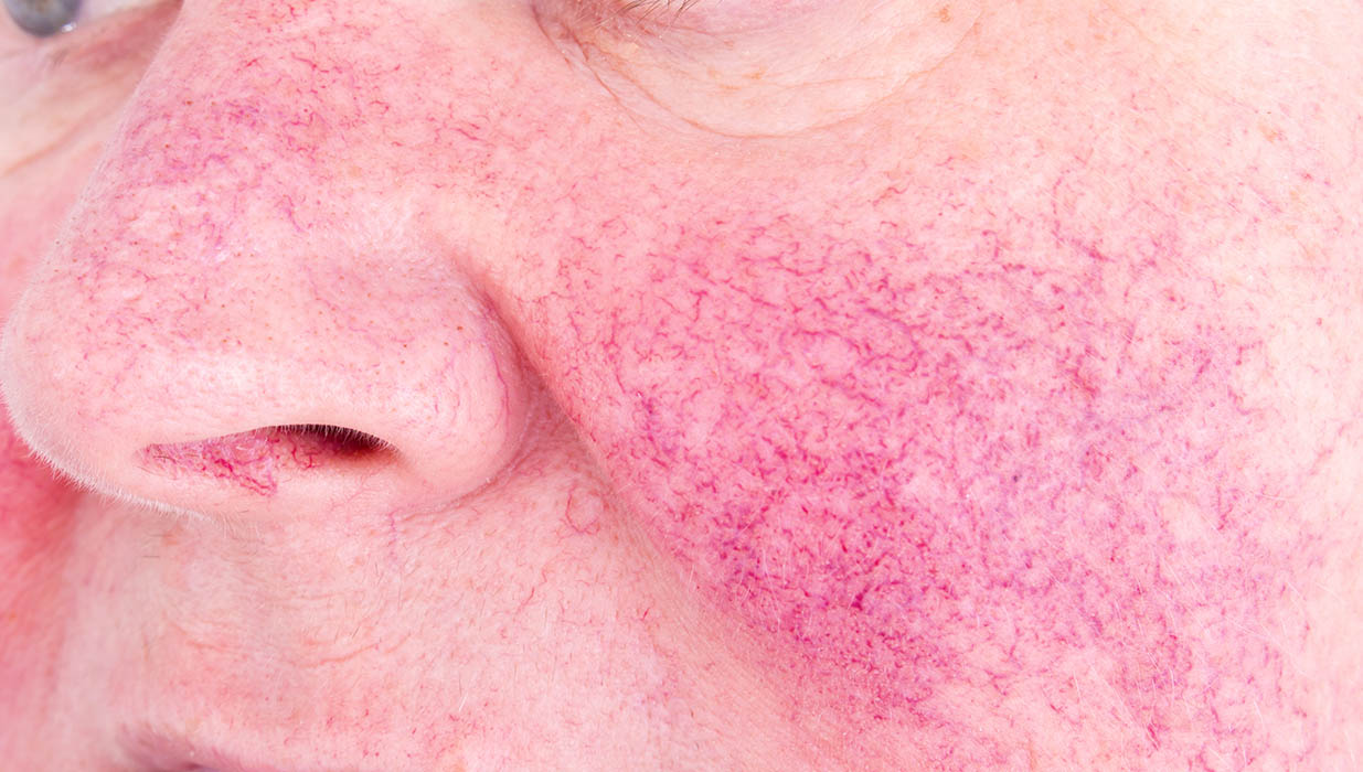 Rougeurs et Vaisseaux - Centre Laser Dermatologique du Limousin